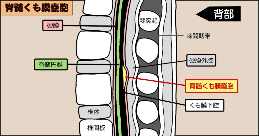 脊髄くも膜嚢胞とは | 再生医療|脳梗塞・脊髄損傷の幹細胞治療|ニューロテックメディカル